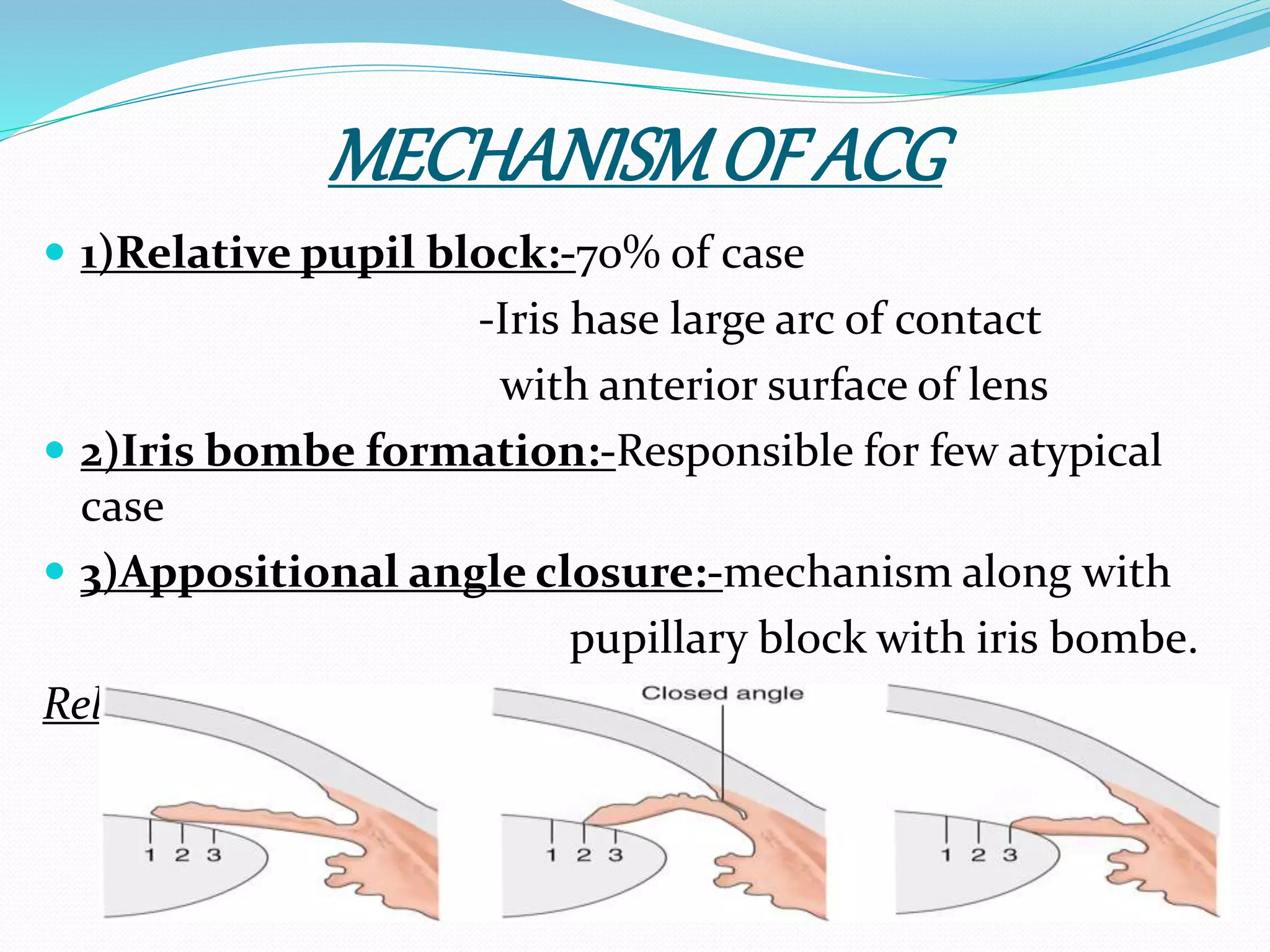 Glaucoma | PPTX