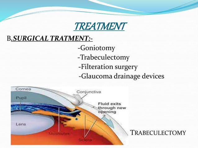 Glaucoma | PPT