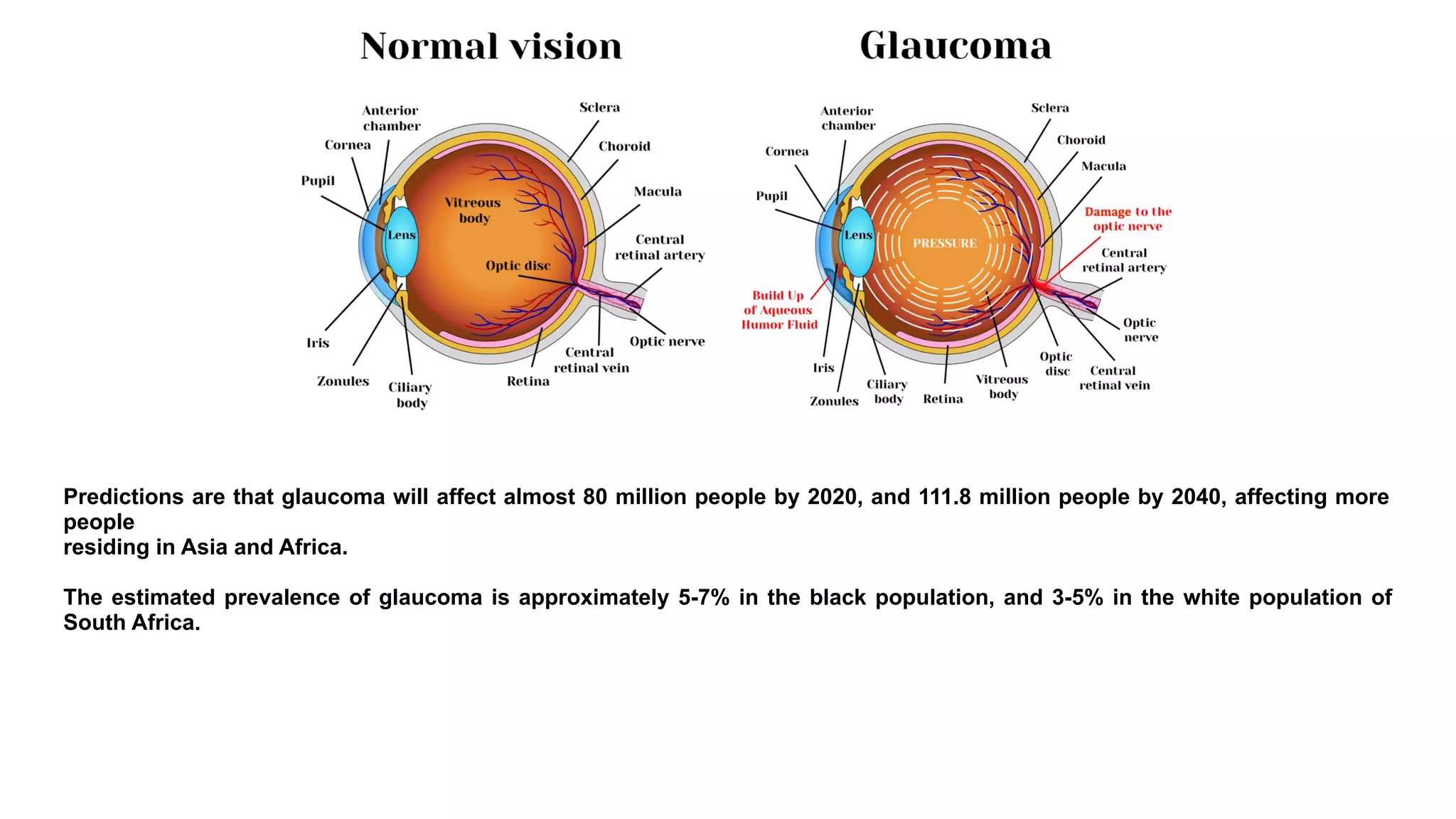 Glaucoma_ a brief review | PPT