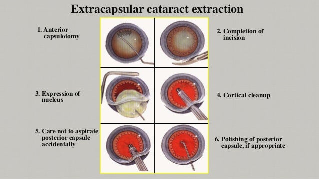 Glaucoma And Cataract Include Treatment