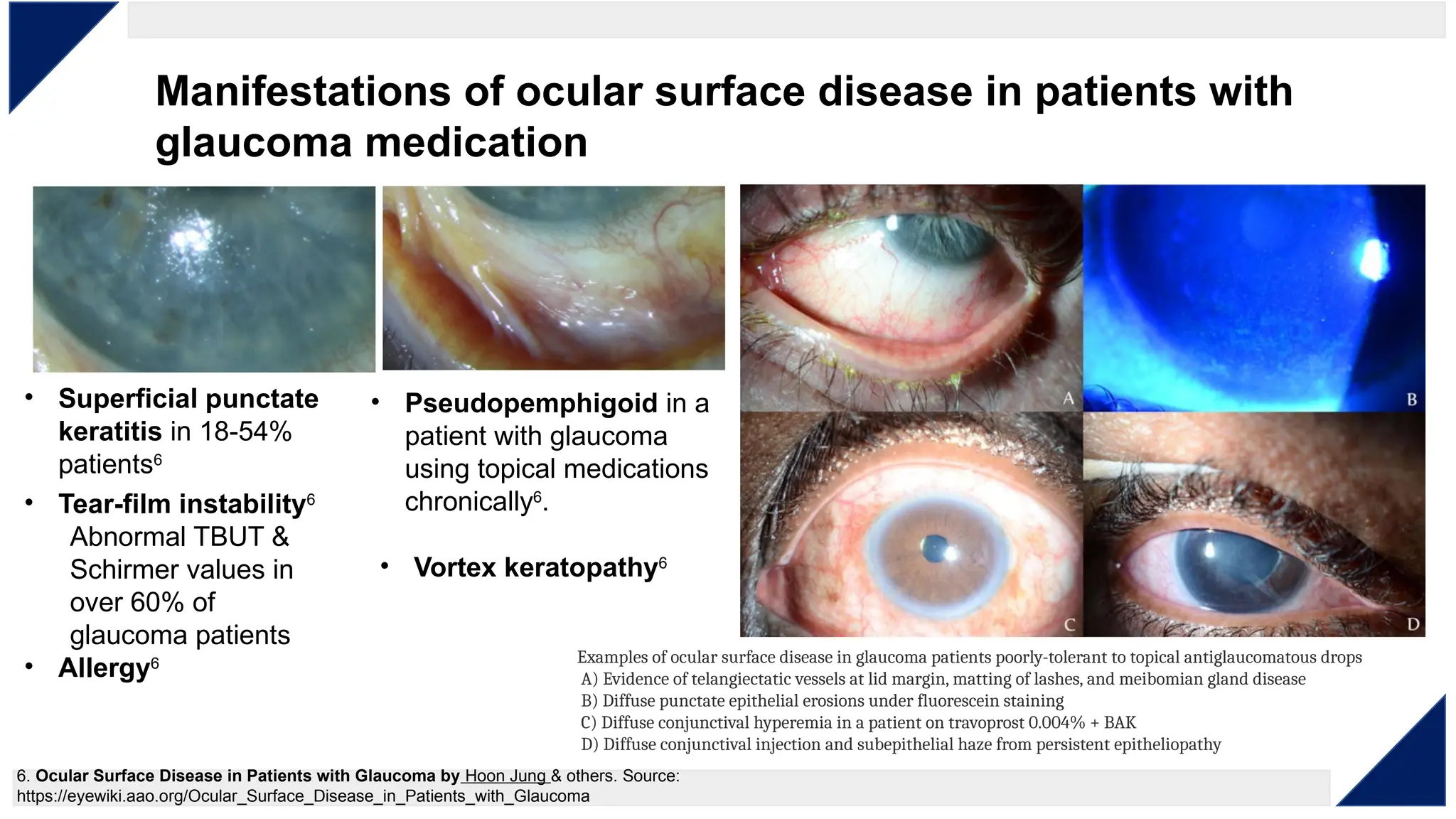 Glaucoma and Dry Eye double trouble. treatment | PPTX