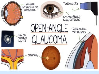 Glaucoma and its classifications.pptx