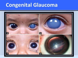 Glaucoma and its classifications.pptx