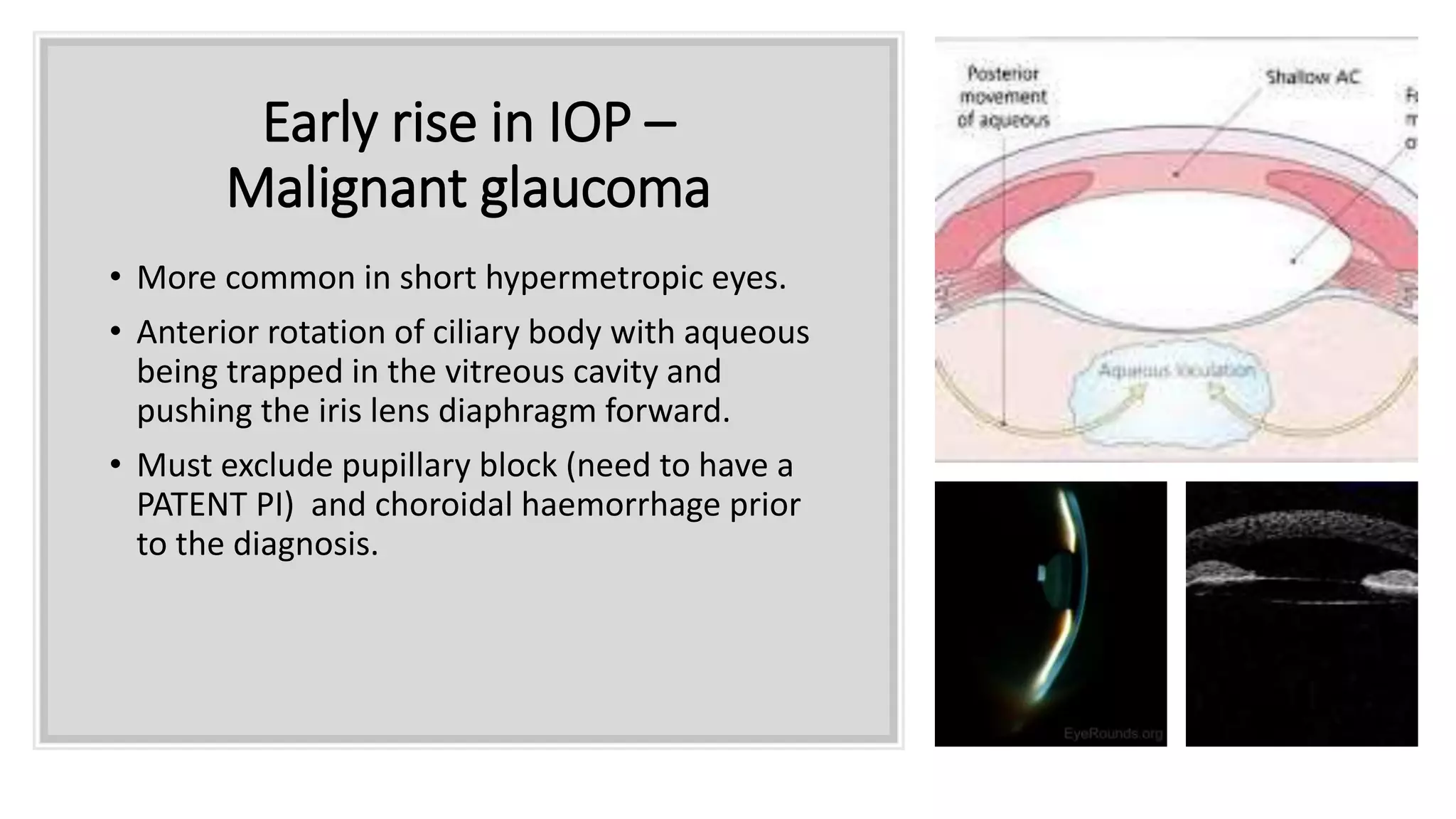Glaucoma post cataract extraction, vitreoretinal surgery, keratoplasty ...