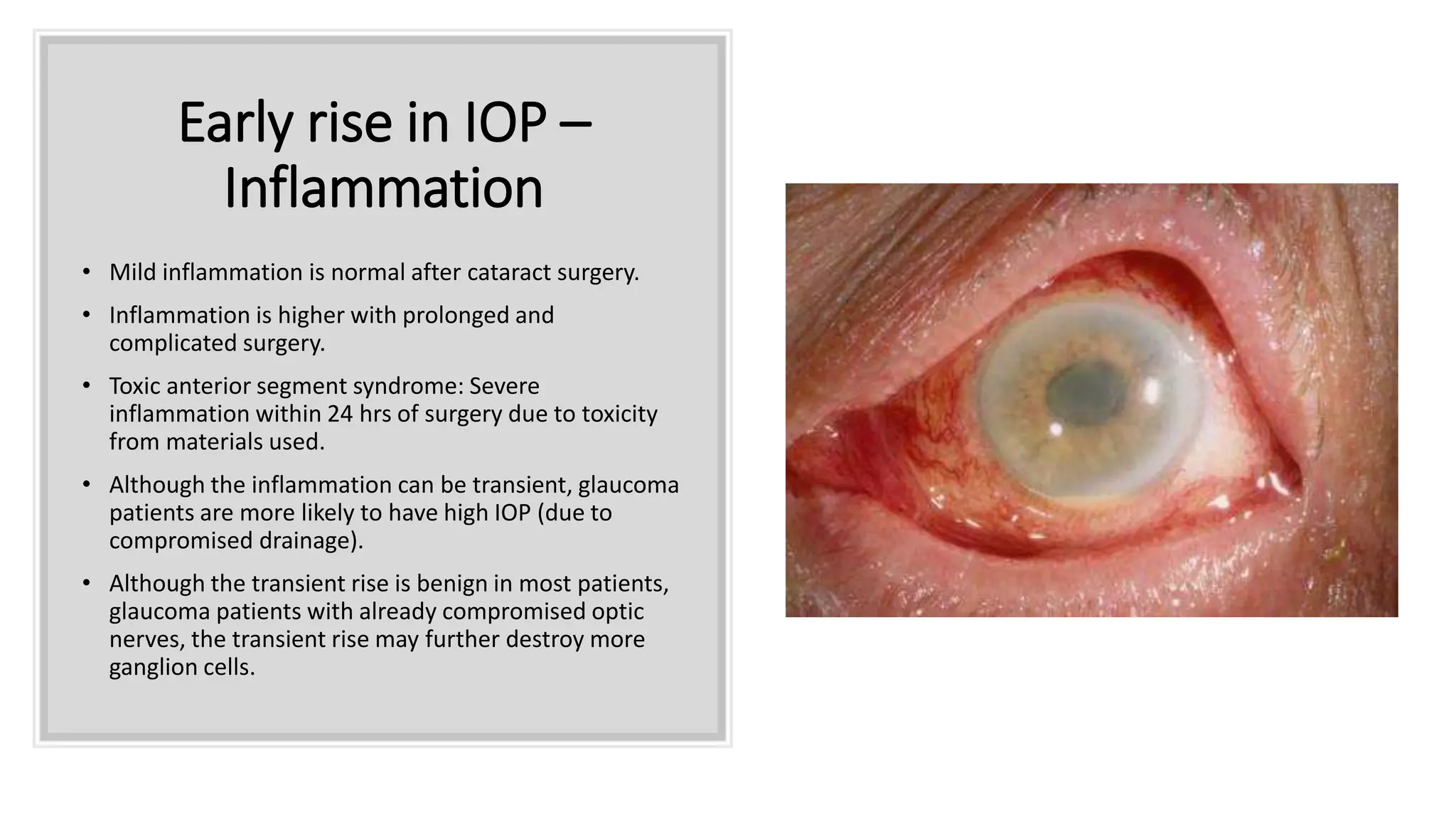 Glaucoma post cataract extraction, vitreoretinal surgery, keratoplasty ...