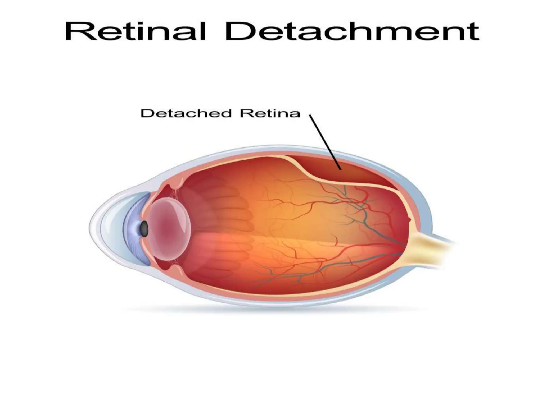 Glaucoma and Retinal detachment.pptx .. | PPTX | Eye and Vision Conditions | Diseases and Conditions