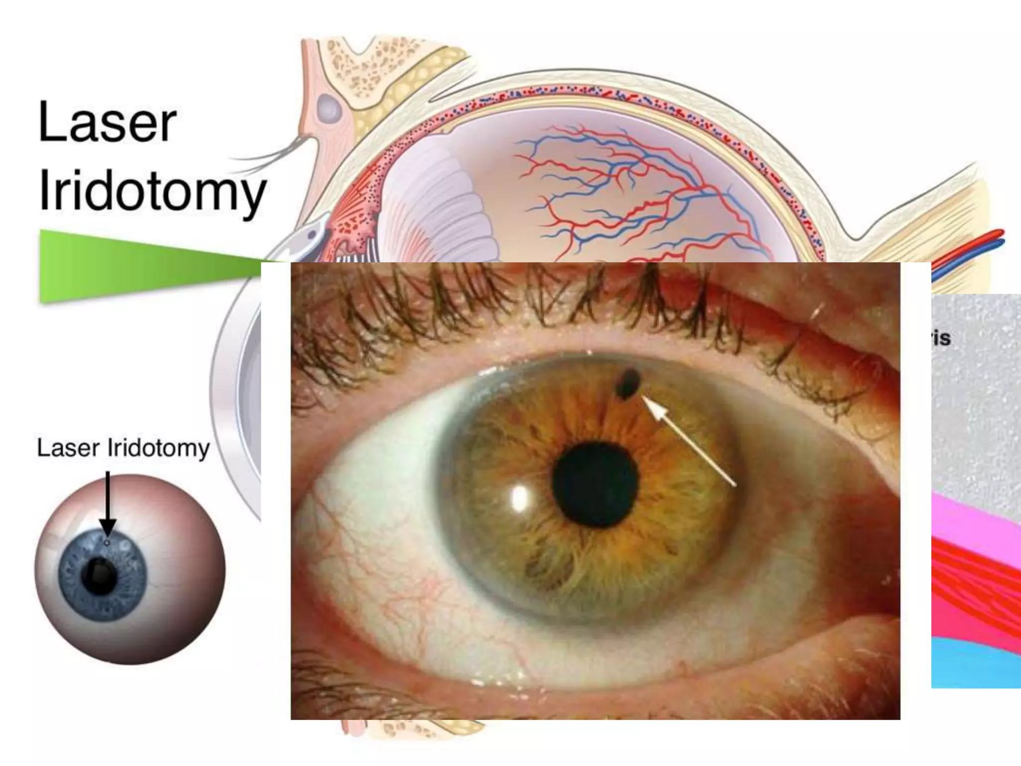 Glaucoma primary closed angle,secondary glaucoma, congenital glaucoma ...