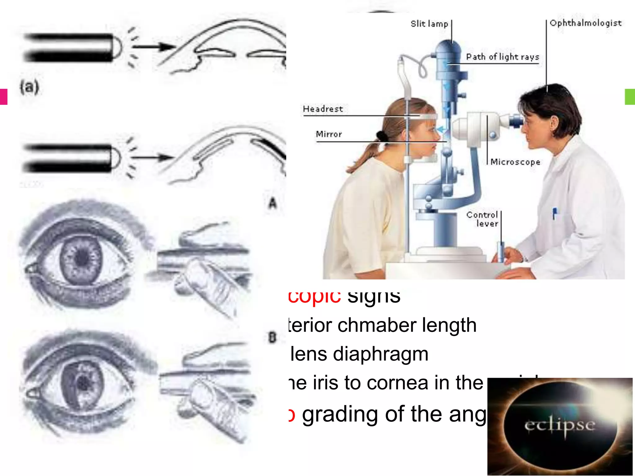 Glaucoma primary closed angle,secondary glaucoma, congenital glaucoma ...