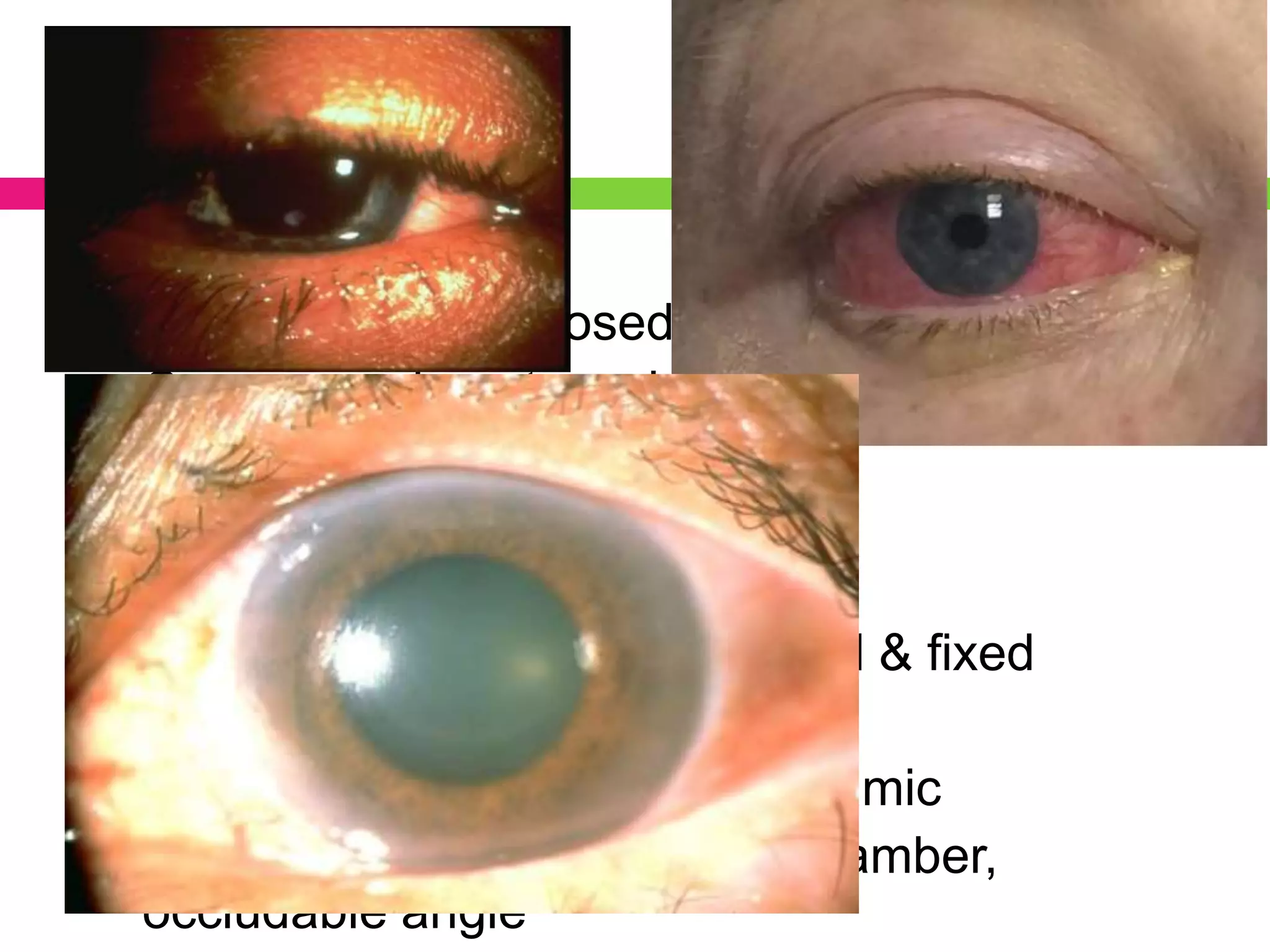 Glaucoma primary closed angle,secondary glaucoma, congenital glaucoma ...