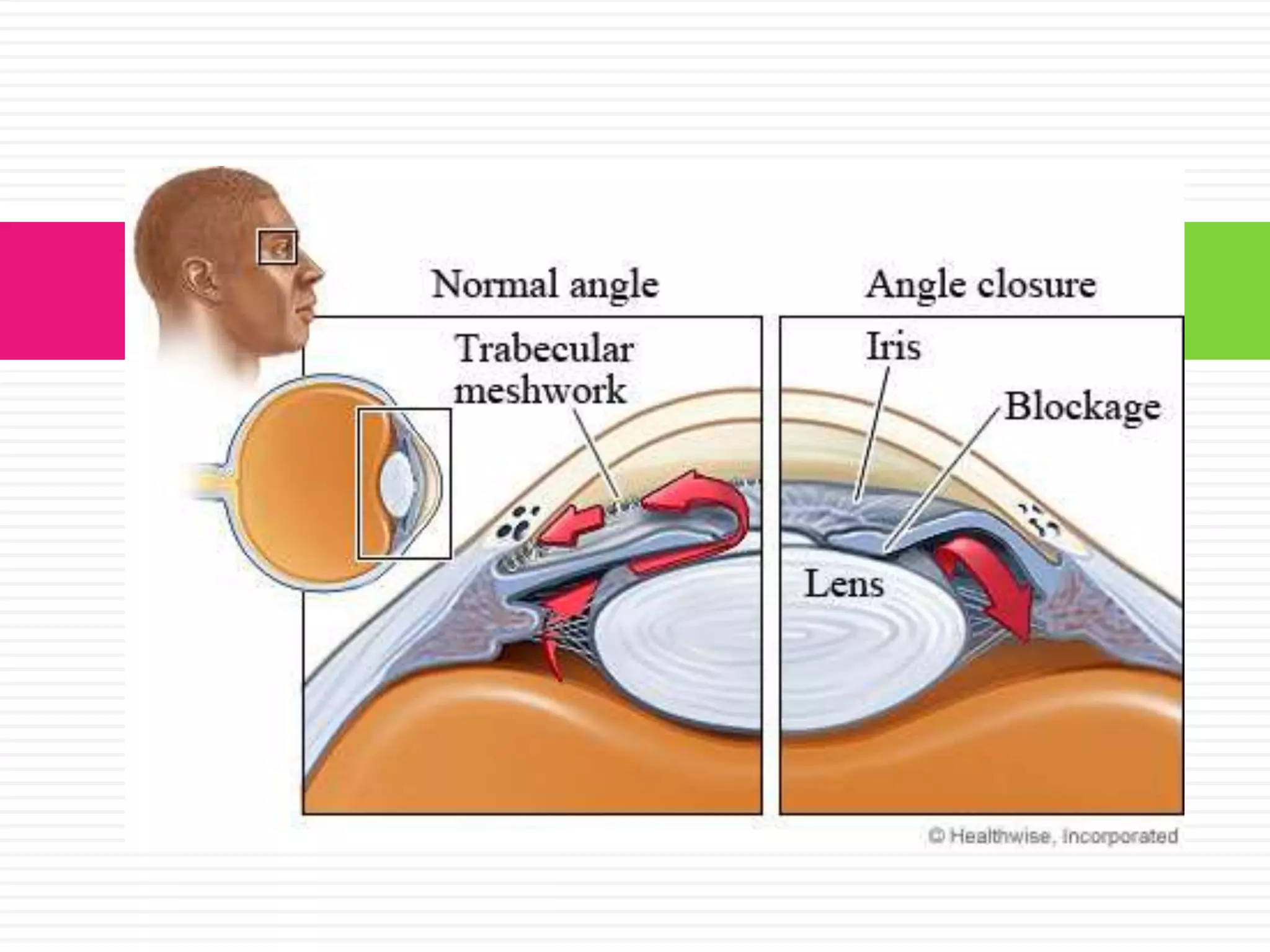 Glaucoma primary closed angle,secondary glaucoma, congenital glaucoma ...