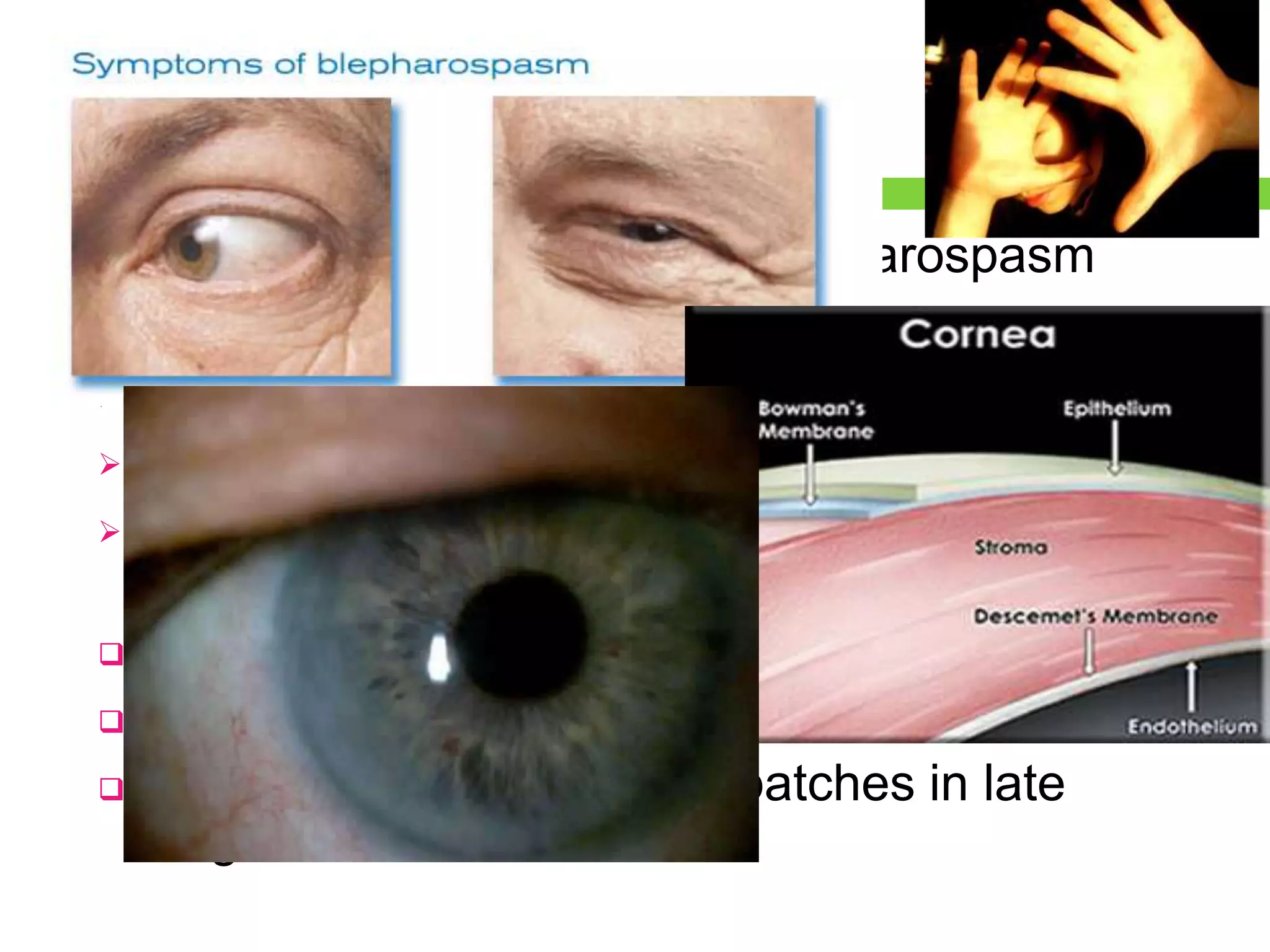 Glaucoma primary closed angle,secondary glaucoma, congenital glaucoma ...