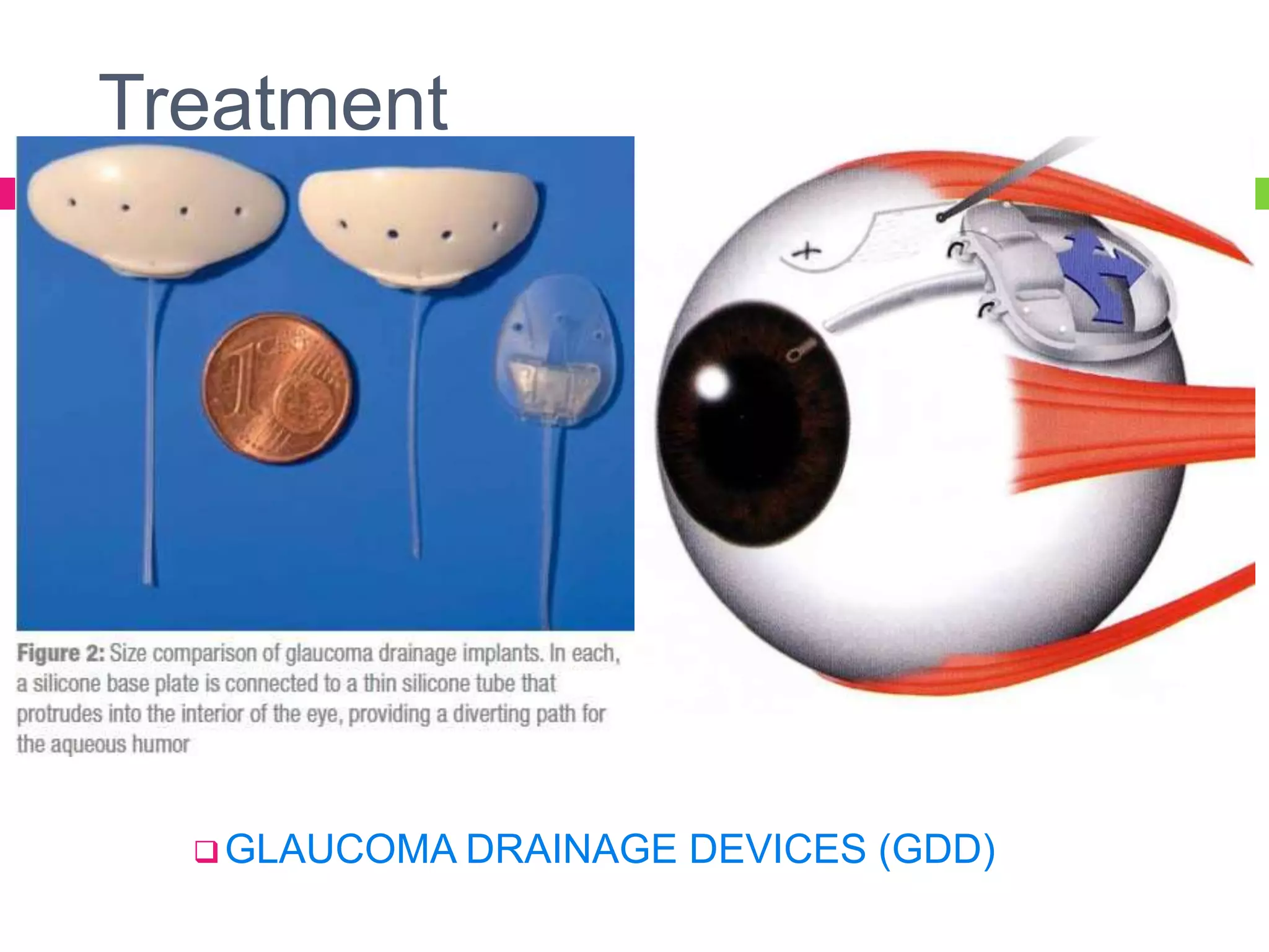Glaucoma primary closed angle,secondary glaucoma, congenital glaucoma ...