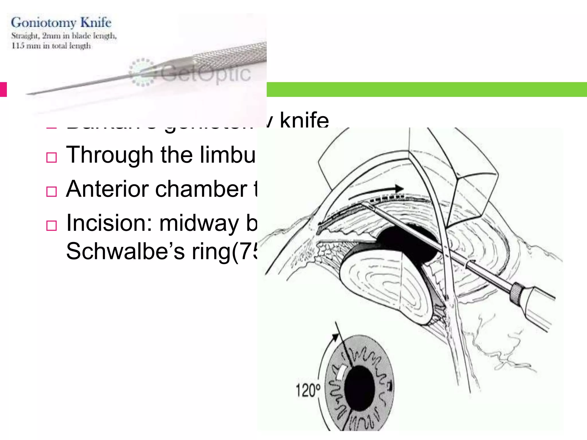 Glaucoma primary closed angle,secondary glaucoma, congenital glaucoma ...