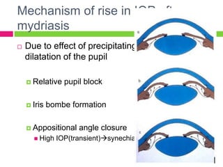 Glaucoma primary closed angle,secondary glaucoma, congenital glaucoma ...