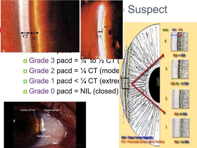 Glaucoma primary closed angle,secondary glaucoma, congenital glaucoma ...