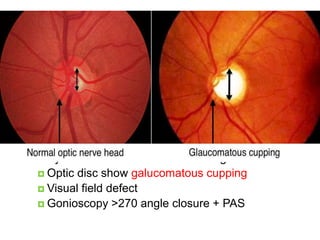 Glaucoma primary closed angle,secondary glaucoma, congenital glaucoma ...