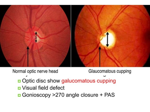 Glaucoma primary closed angle,secondary glaucoma, congenital glaucoma ...