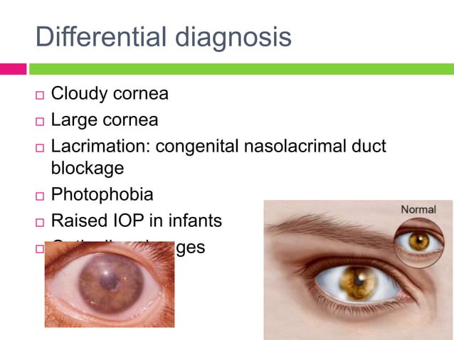 Glaucoma primary closed angle,secondary glaucoma, congenital glaucoma ...