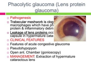 Glaucoma primary closed angle,secondary glaucoma, congenital glaucoma ...