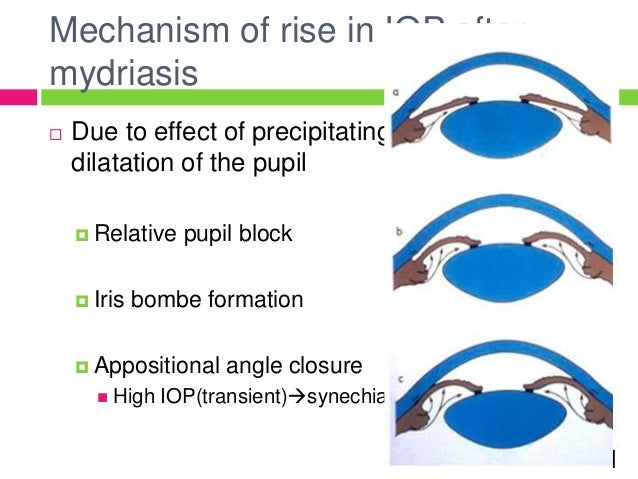 Miosis Vs Mydriasis