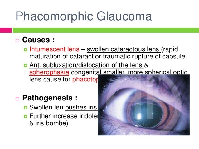 Glaucoma primary closed angle,secondary glaucoma, congenital glaucoma
