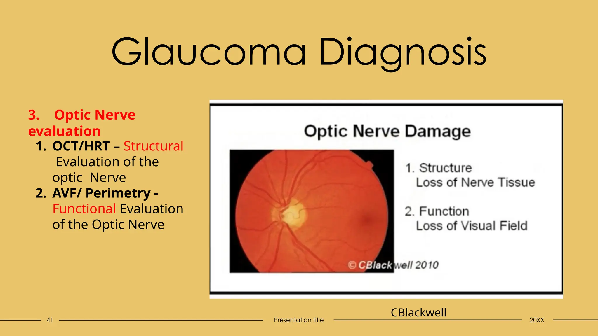 Glaucoma a silent thief of sight, a medical emergency | PPTX