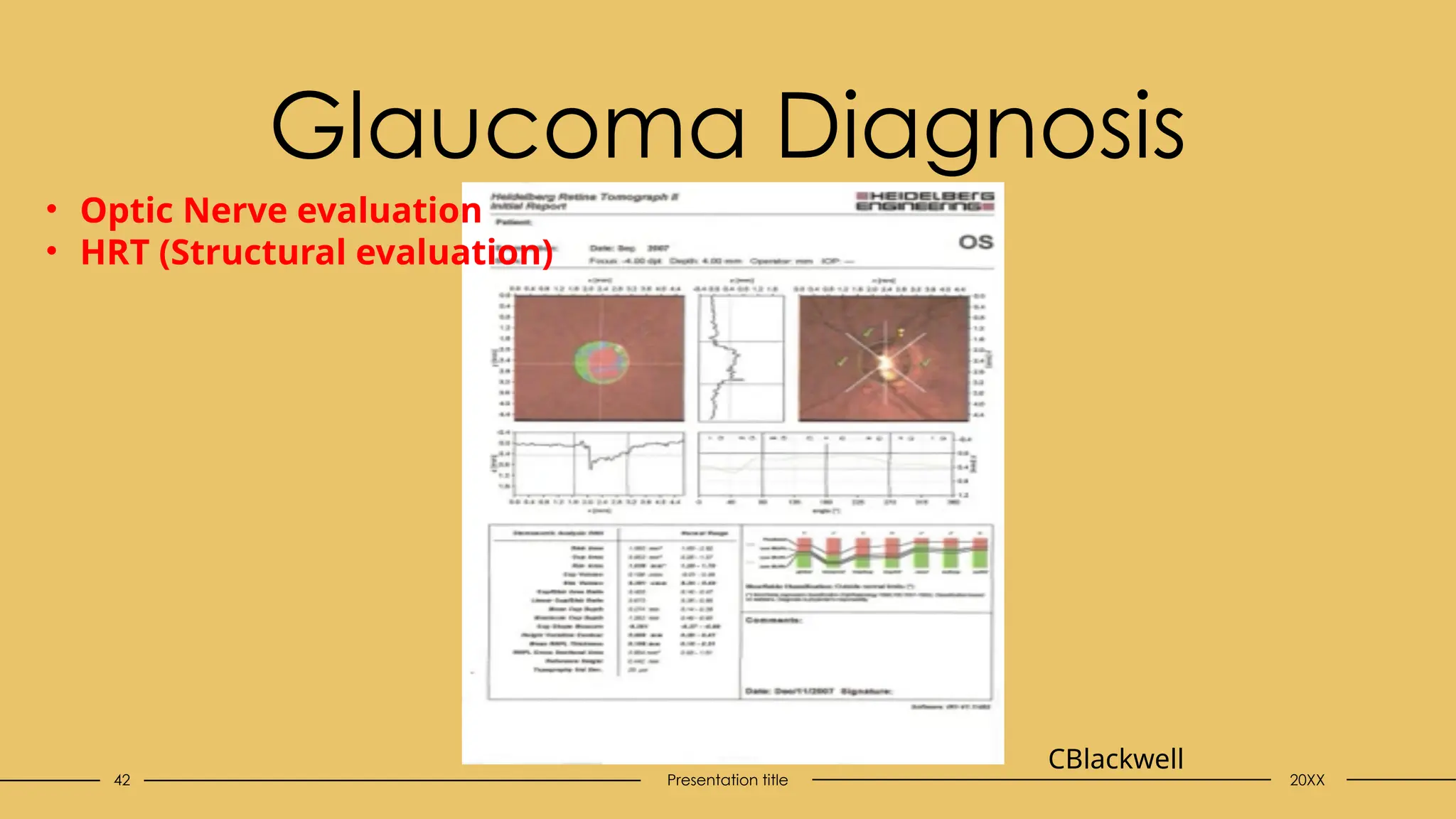 Glaucoma a silent thief of sight, a medical emergency | PPTX
