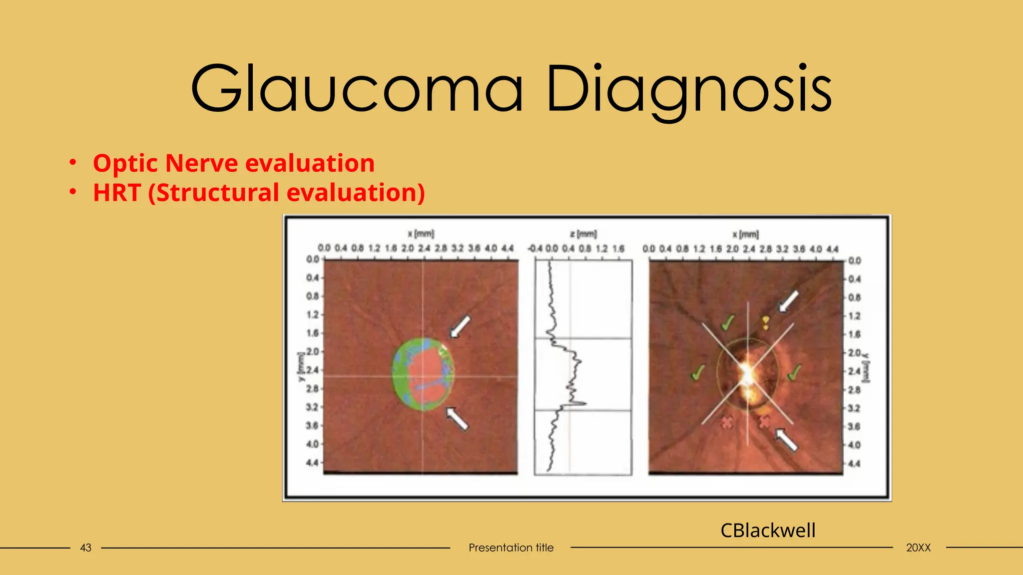 Glaucoma a silent thief of sight, a medical emergency | PPTX