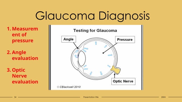 Glaucoma a silent thief of sight, a medical emergency | PPT
