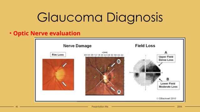Glaucoma a silent thief of sight, a medical emergency | PPT