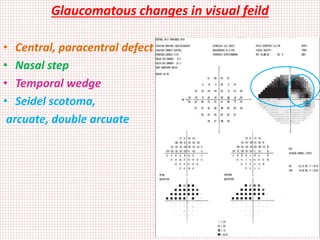 Glaucoma basic principles part 1 | PPTX