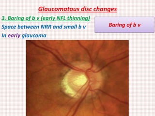 Glaucoma basic principles part 1 | PPT
