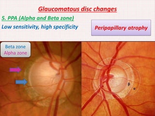Glaucoma basic principles part 1 | PPT