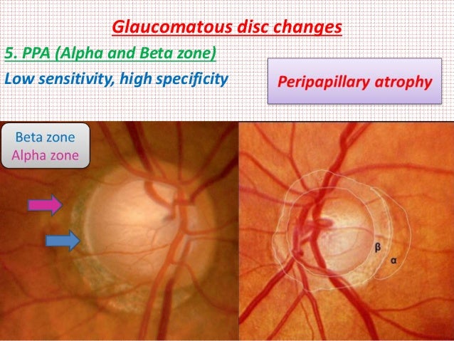Glaucoma basic principles part 1