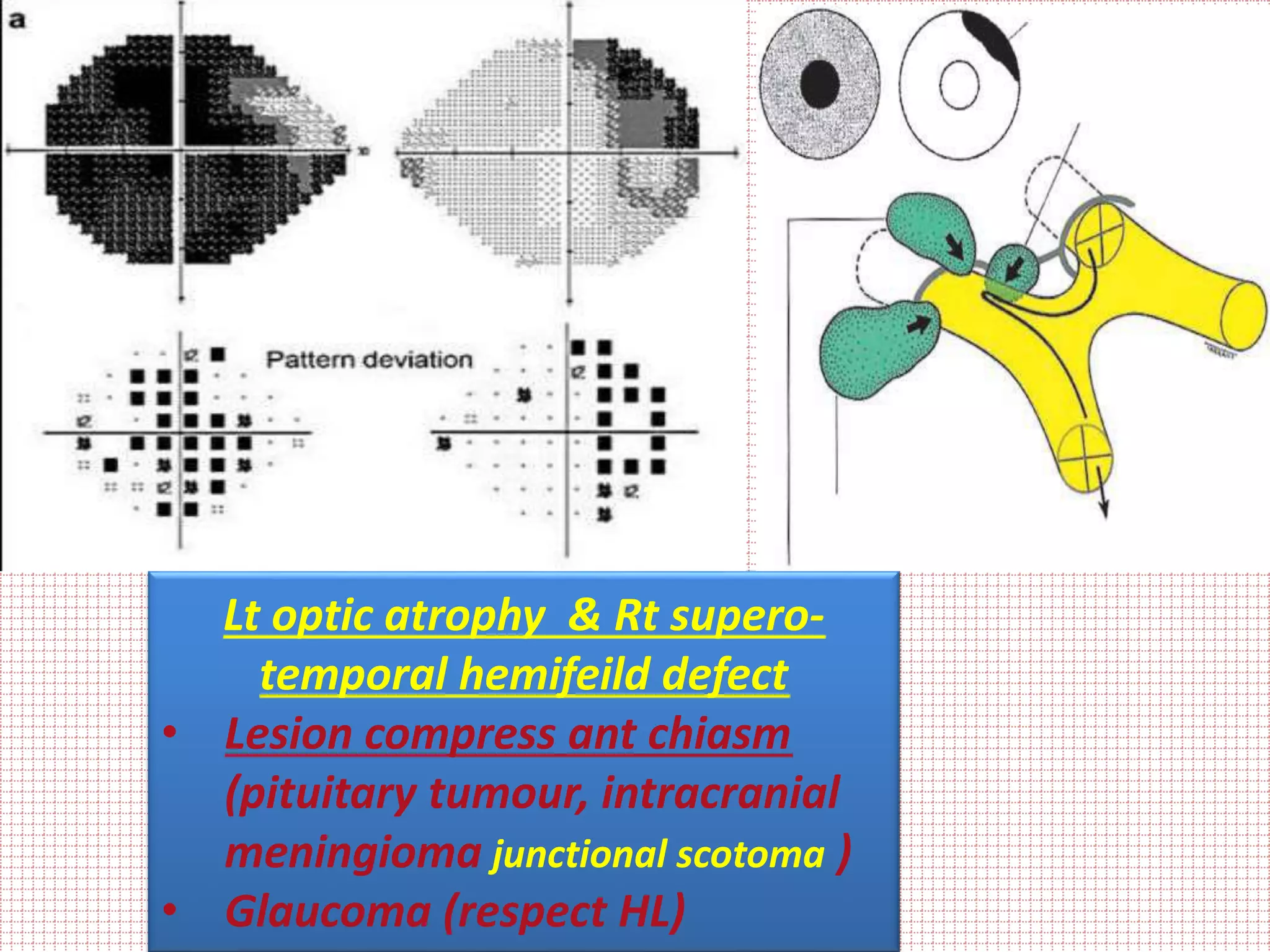 Glaucoma basic principles part 2 | PPTX