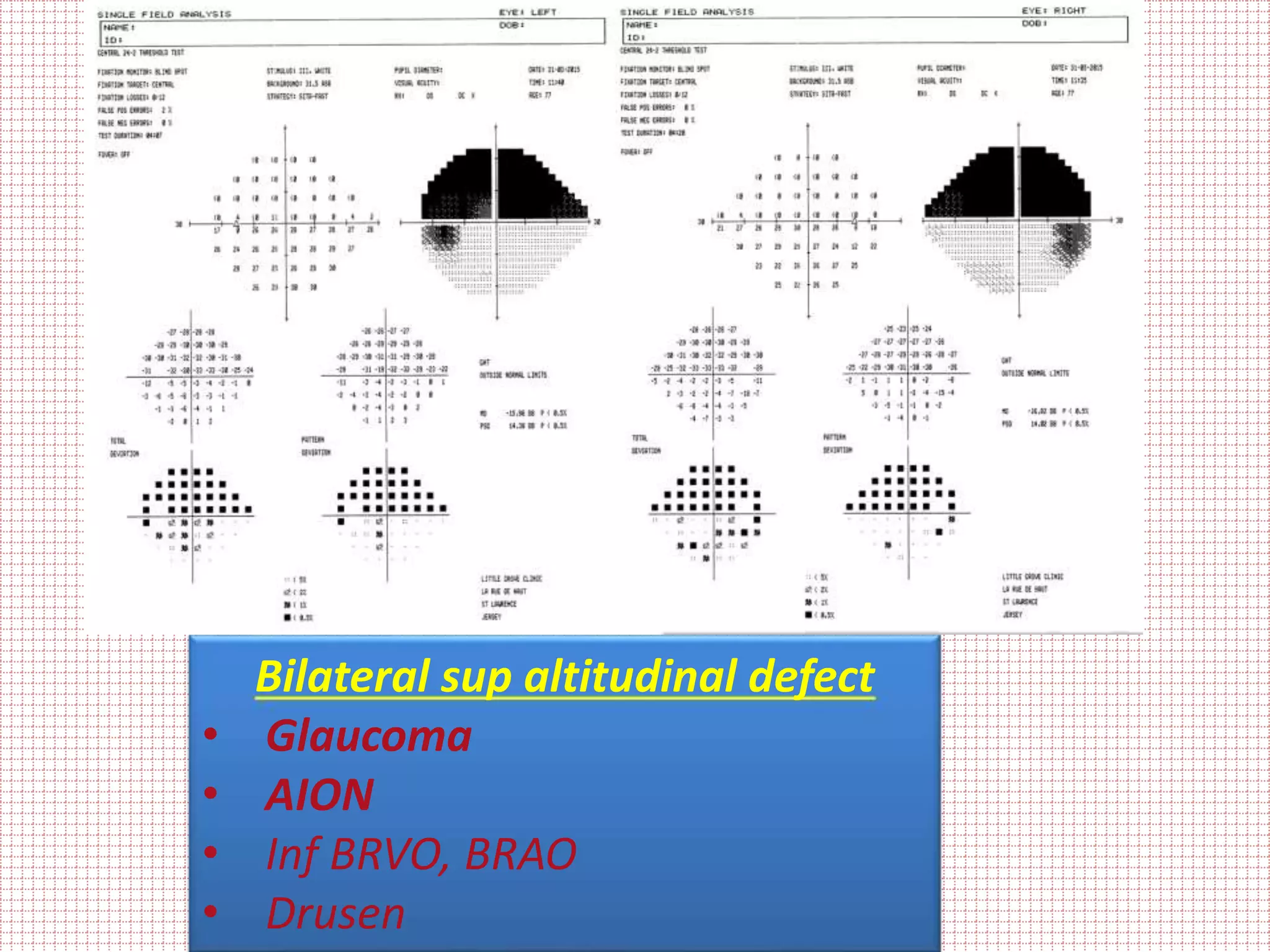 Glaucoma basic principles part 2 | PPTX