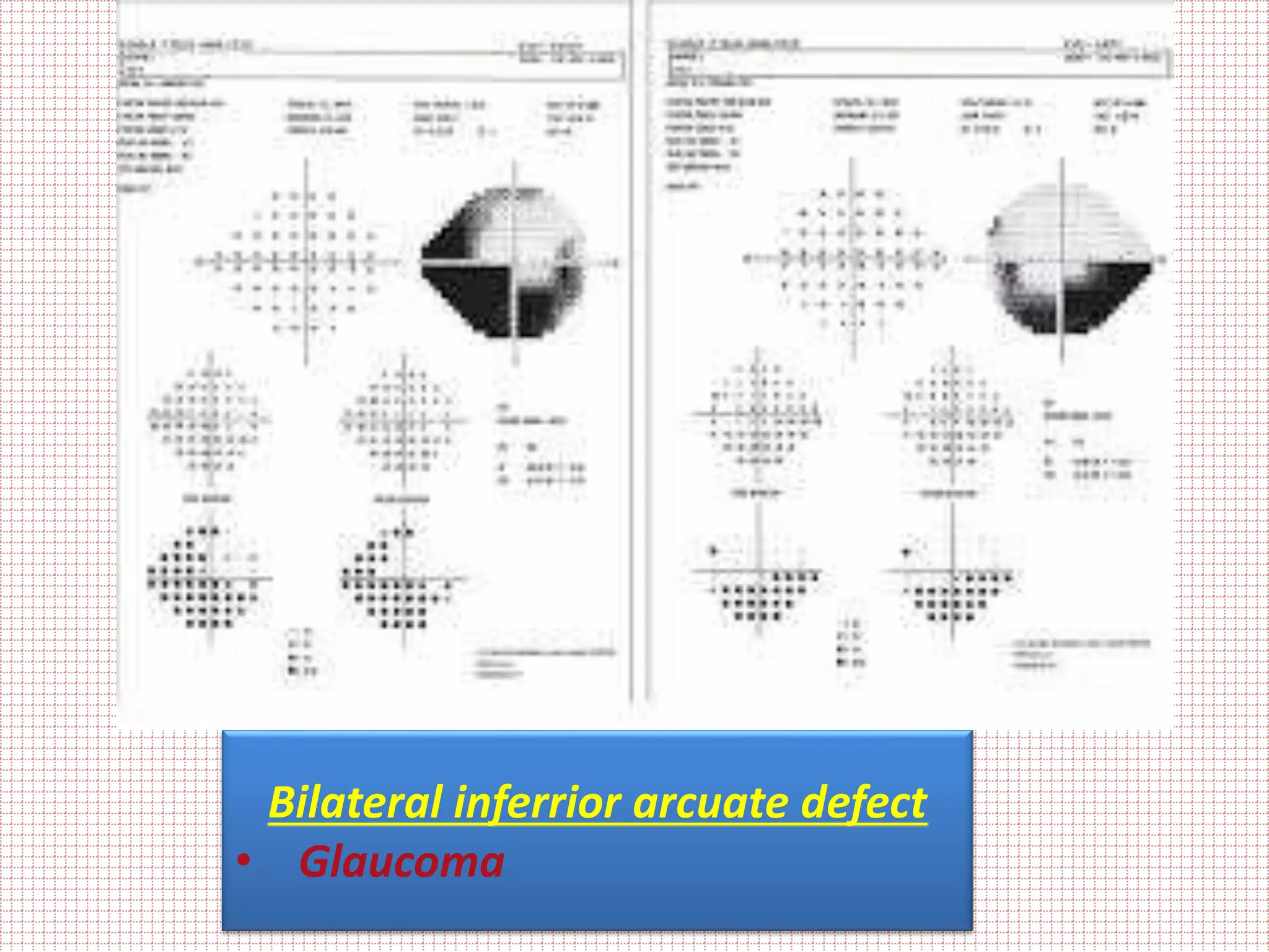 Glaucoma basic principles part 2 | PPTX