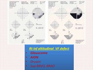 Glaucoma basic principles part 2 | PPTX | Eye and Vision Conditions ...