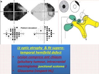 Glaucoma basic principles part 2 | PPTX