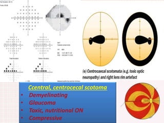 Glaucoma basic principles part 2 | PPTX | Eye and Vision Conditions ...