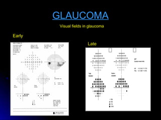 Glaucoma basics and pcg | PPT | Eye and Vision Conditions | Diseases ...