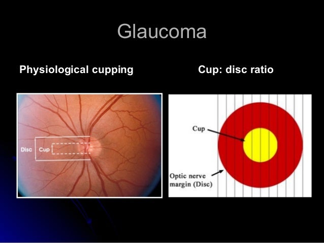 Glaucoma basics and pcg