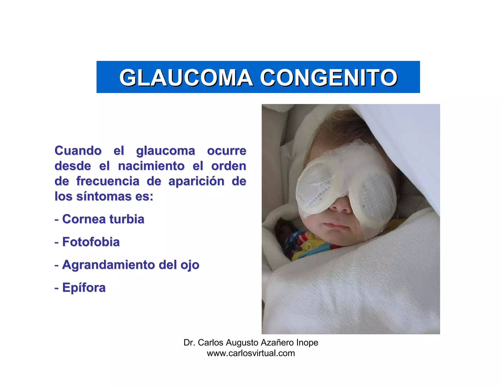Glaucoma congenito | PDF