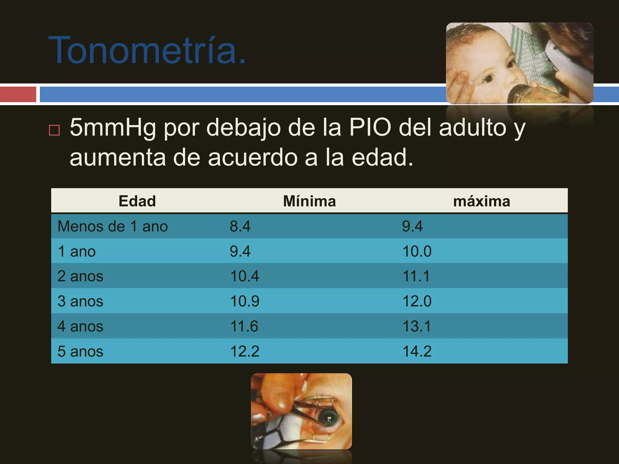 Glaucoma congenito | PPTX