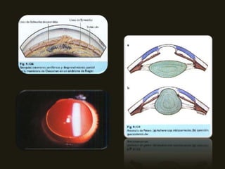 Glaucoma congenito | PPTX