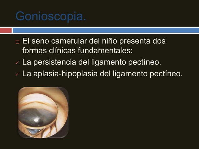 Glaucoma congenito | PPTX