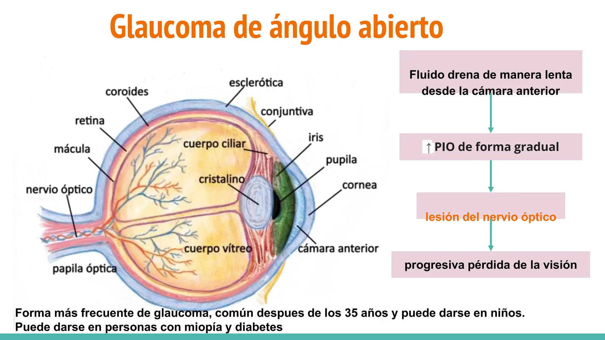 Glaucoma de ángulo abierto y ángulo estrecho.pptx
