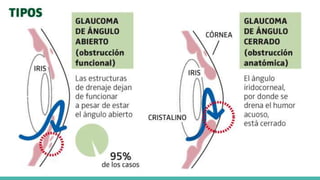 Glaucoma de ángulo abierto y ángulo estrecho.pptx