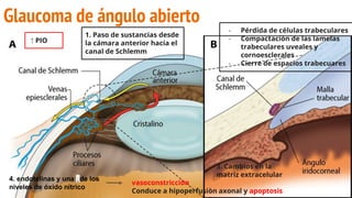 Glaucoma de ángulo abierto y ángulo estrecho.pptx