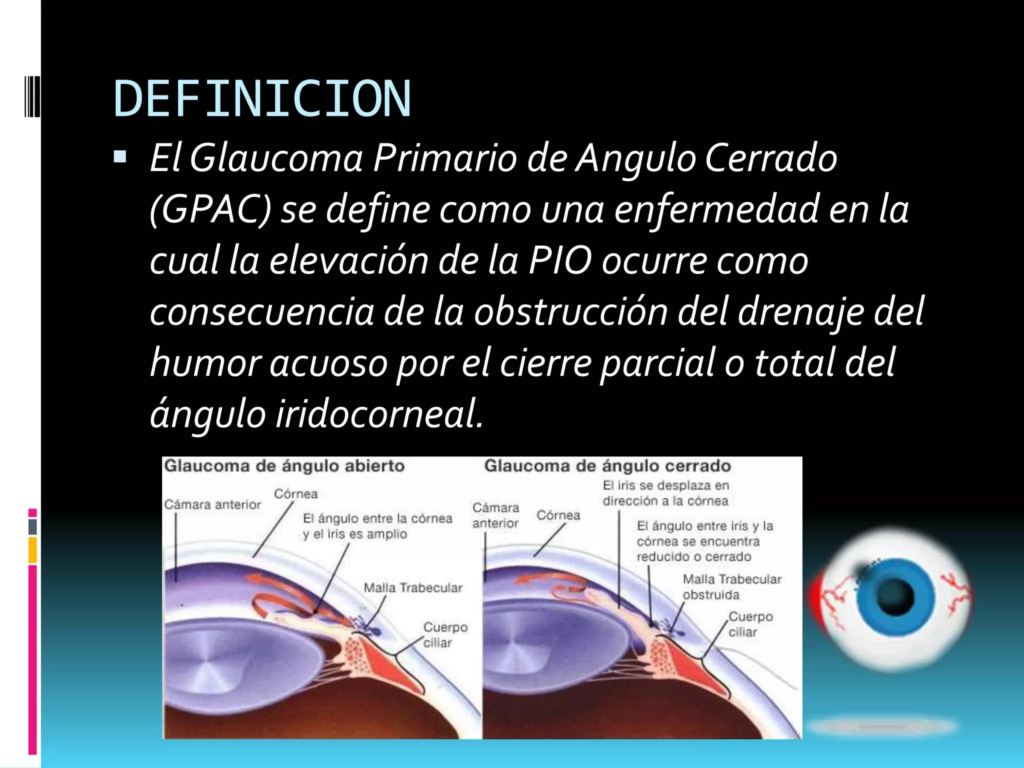 Glaucoma de angulo cerrado by dr glen hernandez | PPT